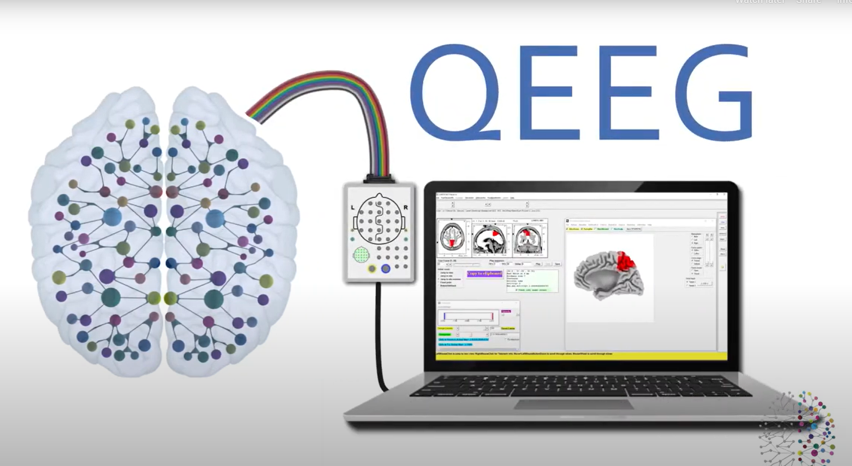 QEEG Brain Maps - Southern Psychology & Neurotherapy